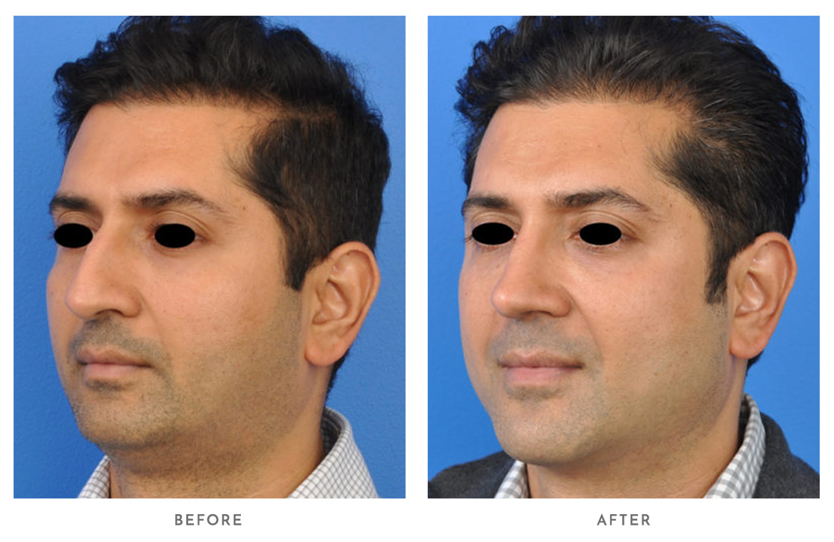 Male Genioplasty Chicago | Chin Augmentation For Men IL