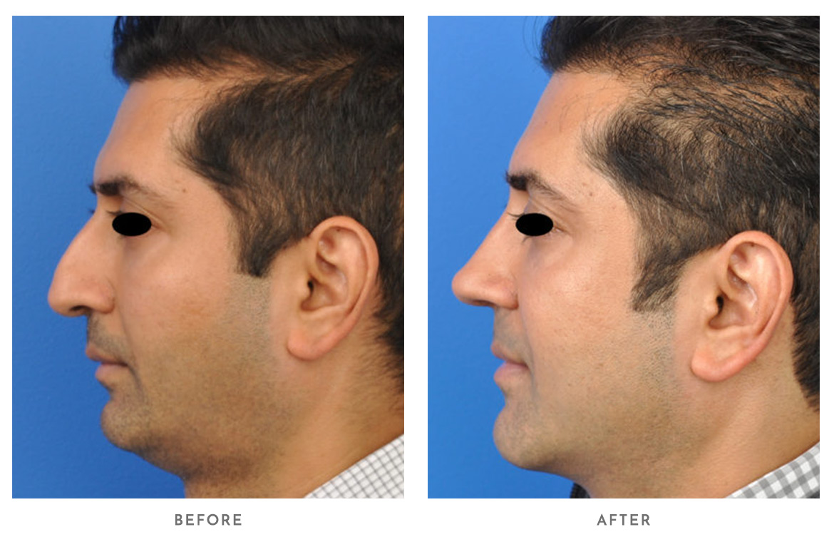 Male Genioplasty Chicago | Chin Augmentation For Men IL