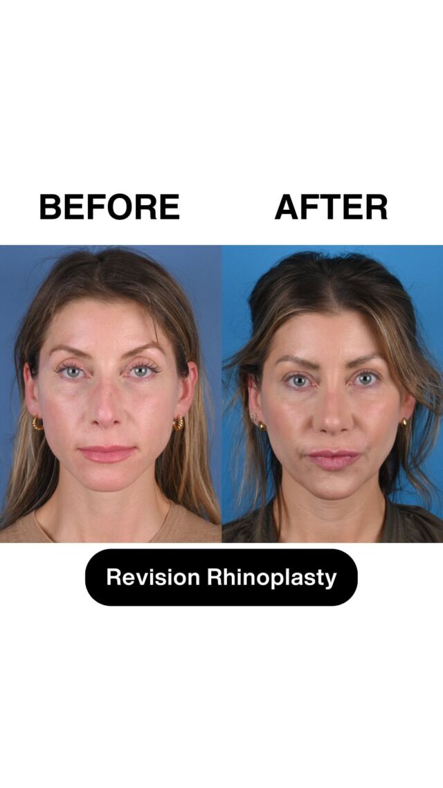 Ideal Nose Shape: Key Factors for Perfect Balance & Harmony