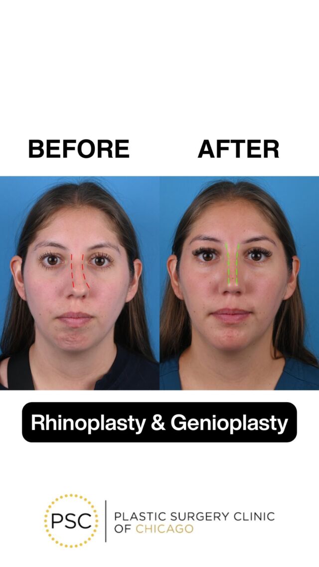 Ideal Nose Shape: Key Factors for Perfect Balance & Harmony